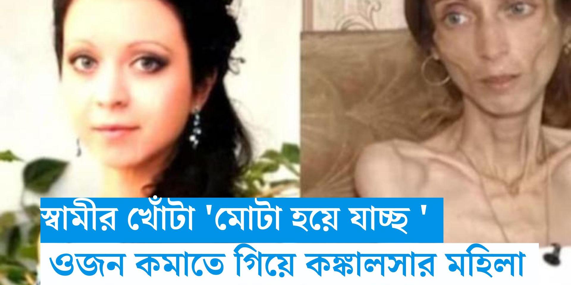 A Russian woman became frighteningly scrawny after reducing weight ...