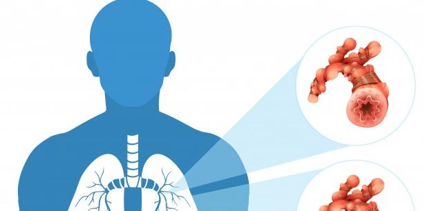 Acute Bronchitis: Find out how is it different from common cold and flu ...