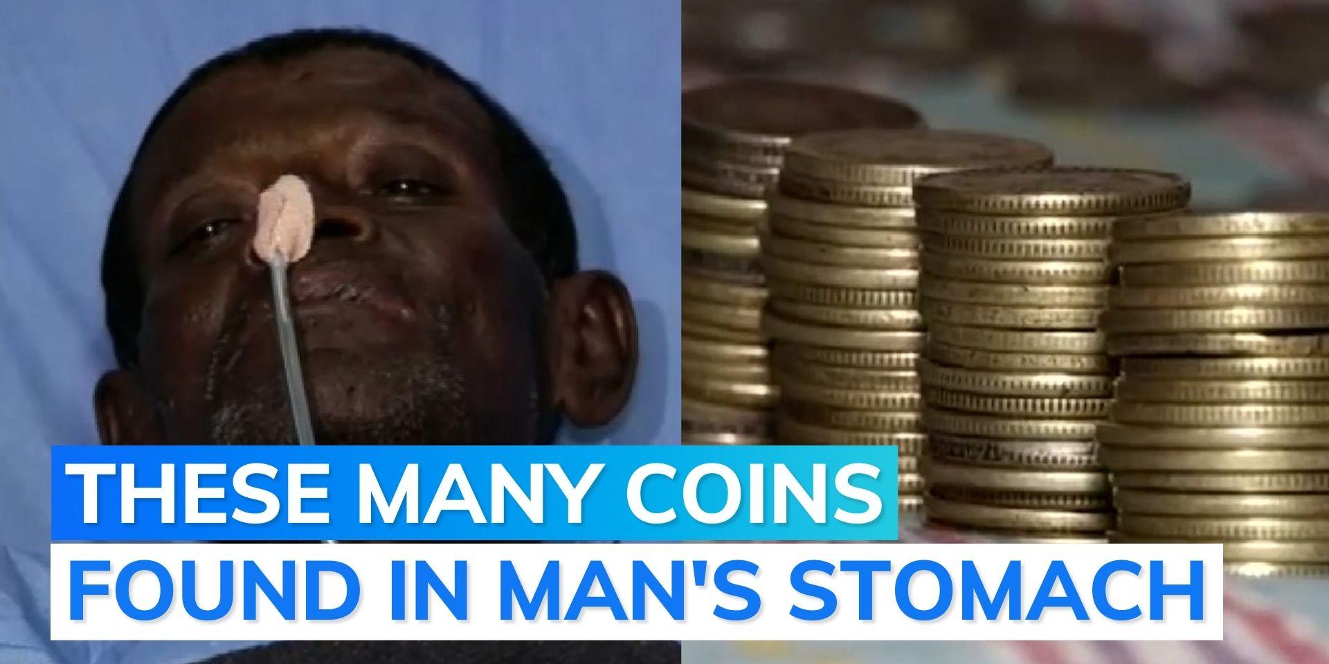 Karnataka: Doctors remove 187 coins from a patient‘s stomach | Editorji