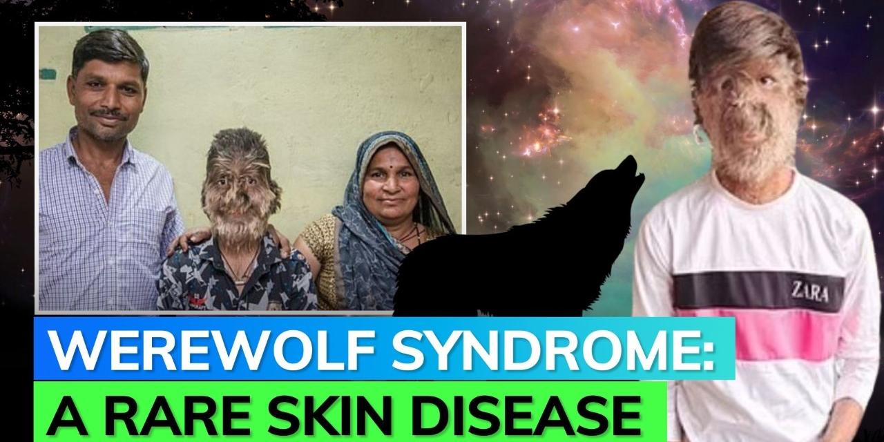 Madhya Pradesh boy shares his experience of living with a rare case of ...